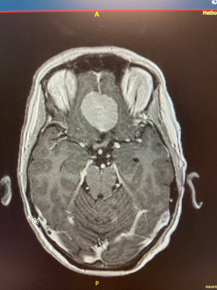 Before Brain Surgery– Diagnosis and Preparation – Ms. Marcia's Mom-ologues